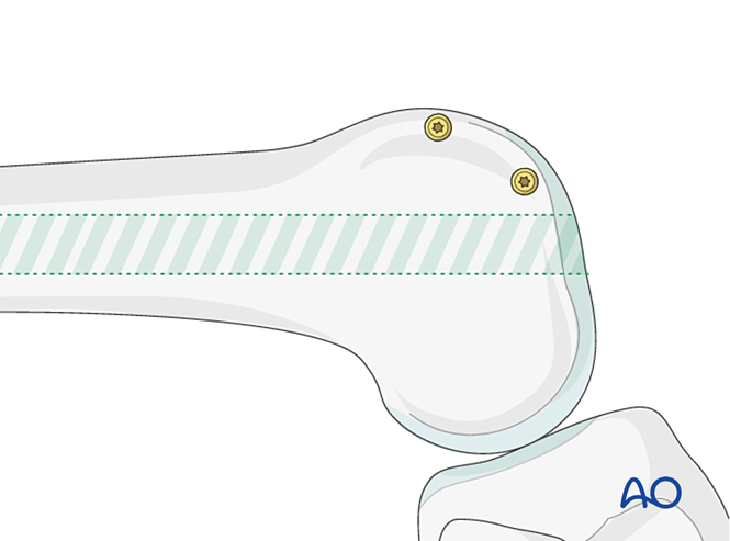 ORIF - Lag screw (epiphysis); MIO - Retrograde nailing for Complete ...