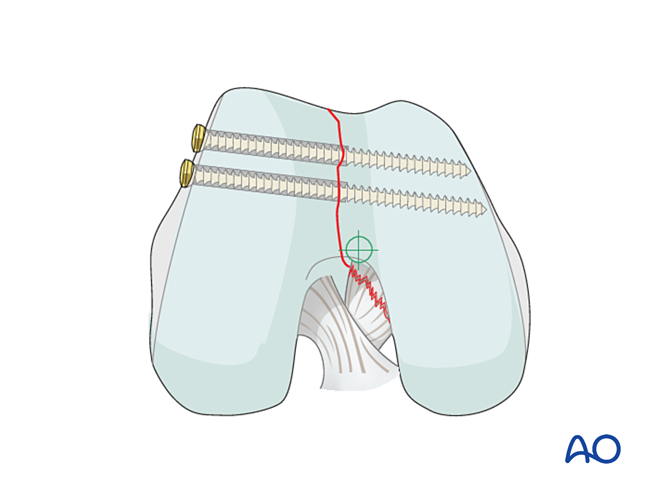 ORIF - Lag screw (epiphysis); MIO - Retrograde nailing for Complete ...