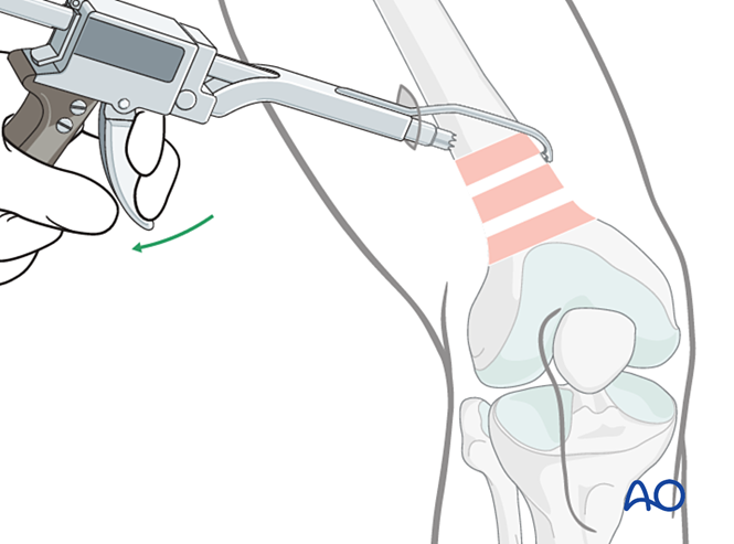 ORIF - Lag screw (epiphysis); MIO - Retrograde nailing for Complete ...