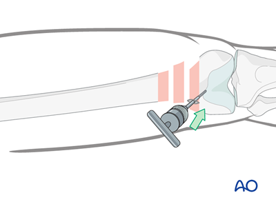ORIF - Lag screw (epiphysis); MIO - Retrograde nailing for Complete ...