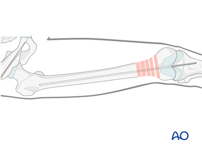 ORIF - Lag screw (epiphysis); MIO - Retrograde nailing for Complete ...