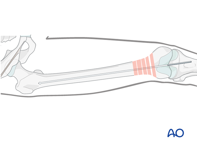 MIO - Retrograde nailing for Extraarticular fracture, wedge