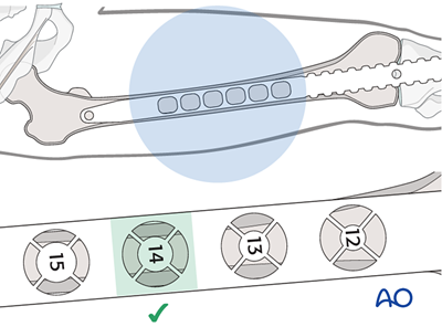 MIO - Retrograde nailing for Extraarticular fracture, multifragmentary