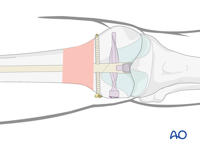 ORIF - Lag screw (epiphysis); MIO - Retrograde nailing for Complete ...