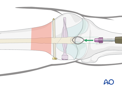 MIO - Retrograde nailing for Extraarticular fracture, simple