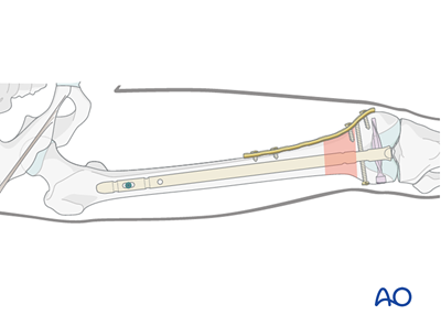 MIO - Retrograde nailing for Extraarticular fracture, simple