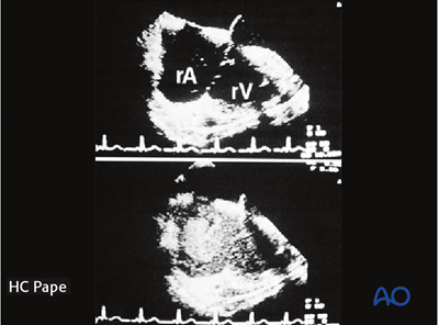 ORIF - Lag screw (epiphysis); MIO - Retrograde nailing for Complete ...