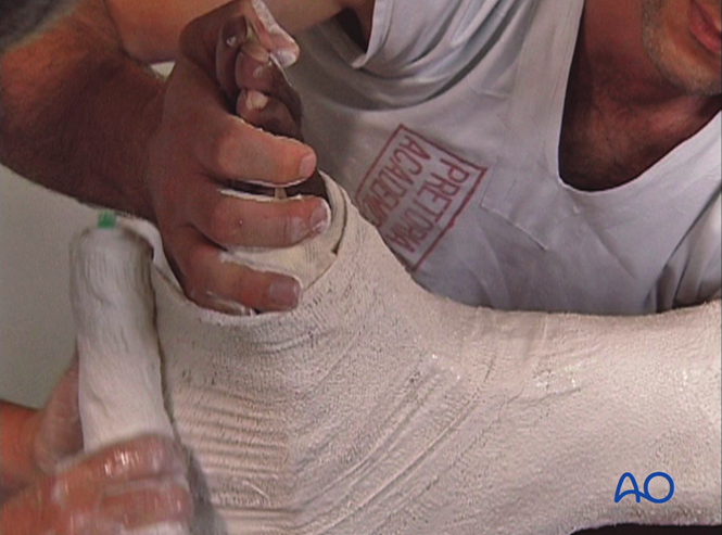 Long leg cast then hinged knee brace for Partial articular fracture ...