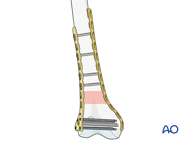 Double plating for Extraarticular fracture, wedge