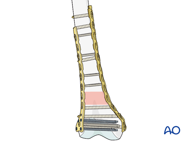 Double plating for Extraarticular fracture, wedge