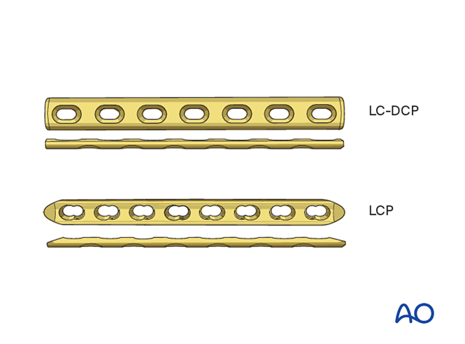 Double plating for Extraarticular fracture, wedge