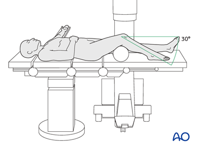 Supine position knee flexed 30°