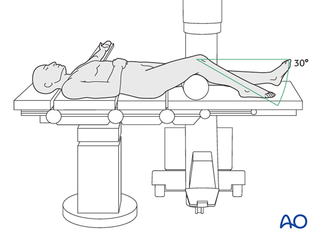 Supine position knee flexed 30°