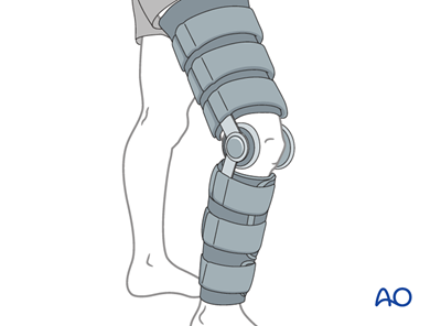 Long leg cast for Fracture around a loose femoral component with poor ...