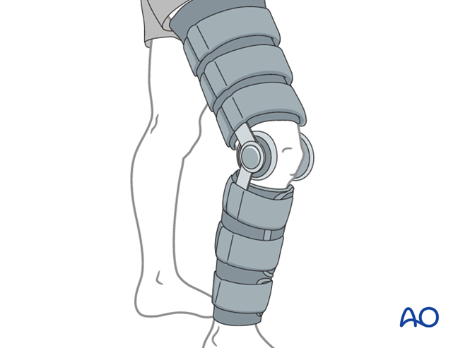 Long leg cast then hinged knee brace for Extraarticular fracture, simple