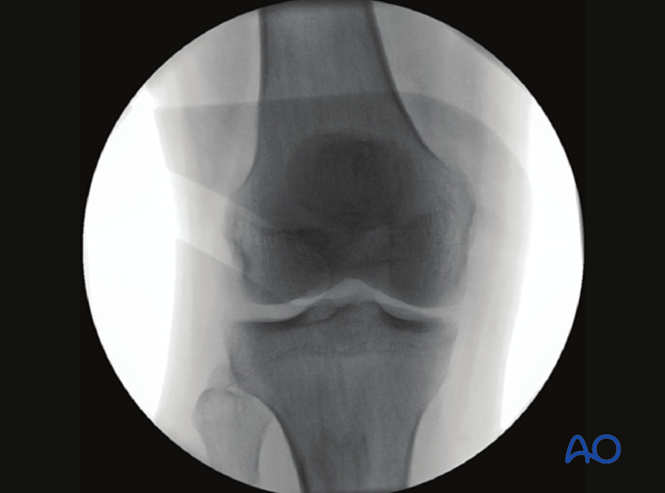 Intraoperative imaging of the distal femur