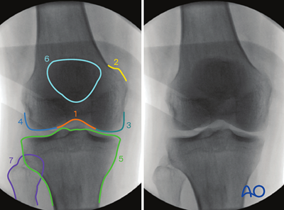 Intraoperative imaging of the distal femur