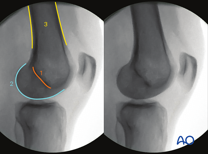 Intraoperative imaging of the distal femur