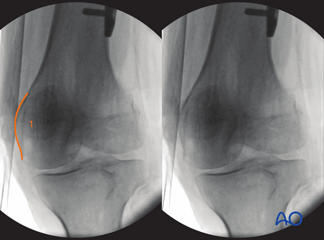 Intraoperative imaging of the distal femur