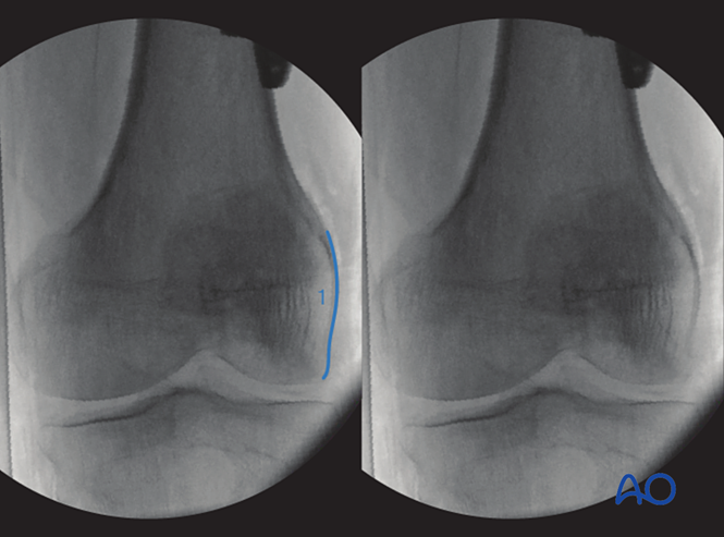 Intraoperative imaging of the distal femur