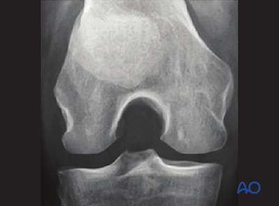 Intraoperative imaging of the distal femur