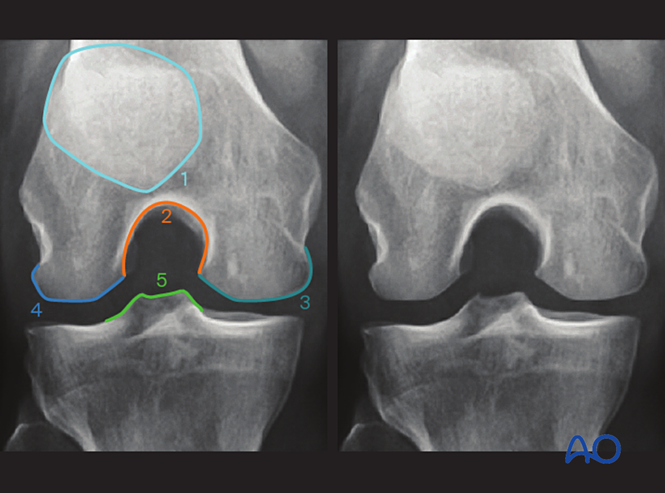 Intraoperative imaging of the distal femur