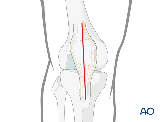 Mid-axial longitudinal approach to the patella