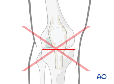 Mid-axial longitudinal approach to the patella