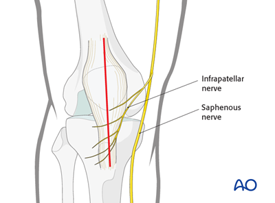 Mid-axial longitudinal approach to the patella