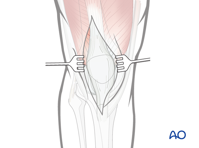 Mid-axial longitudinal approach to the patella