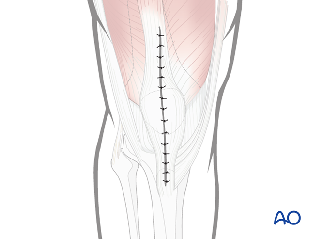 Mid-axial longitudinal approach to the patella
