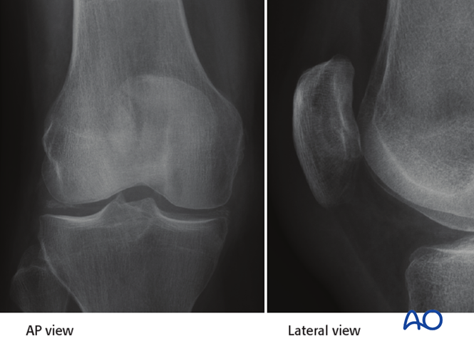 Partial articular, lateral sagittal fragmentary fracture