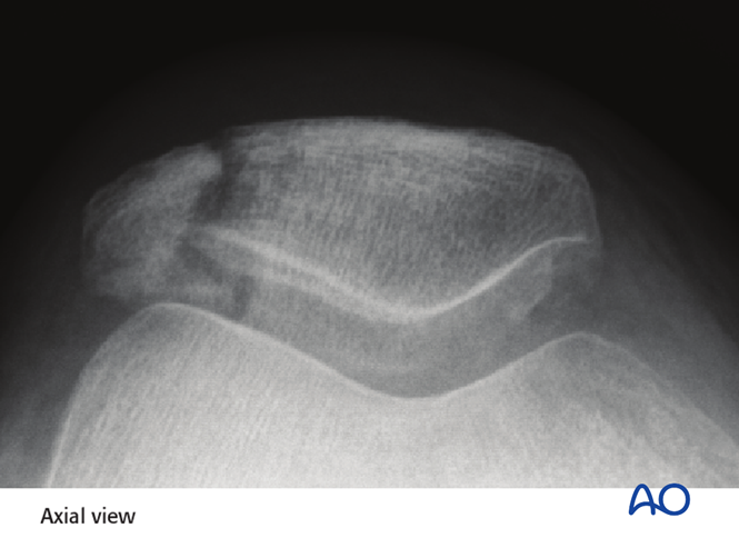 Partial articular, lateral sagittal fragmentary fracture