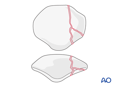 Partial articular, medial sagittal fragmentary fracture