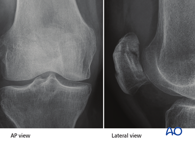 Complete articular, frontal/coronal wedge fracture