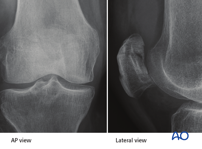 Complete articular, frontal/coronal wedge fracture