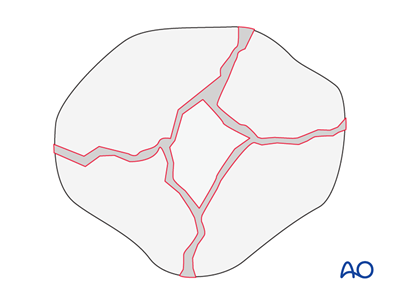 Complete articular, frontal/coronal multifragmentary fracture