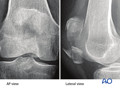 Complete articular, frontal/coronal multifragmentary fracture