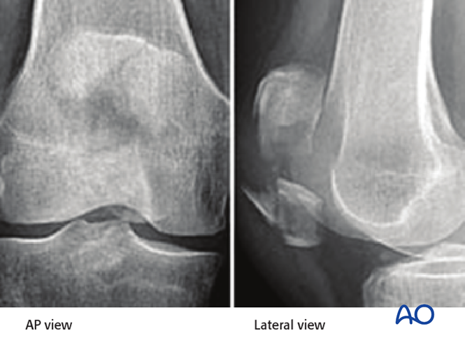 Complete articular, frontal/coronal multifragmentary fracture