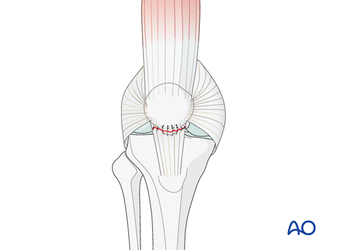 Patellar tendon repair for Extraarticular avulsion fracture
