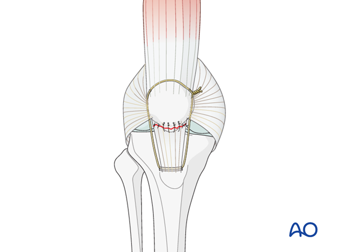Patellar tendon repair for Extraarticular avulsion fracture