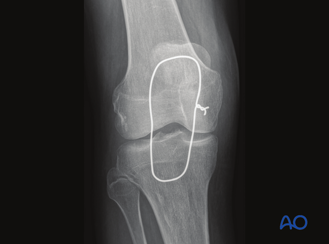 Patellar tendon repair for Extraarticular avulsion fracture