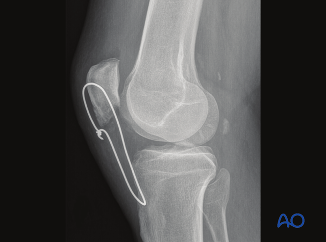 Patellar tendon repair for Extraarticular avulsion fracture