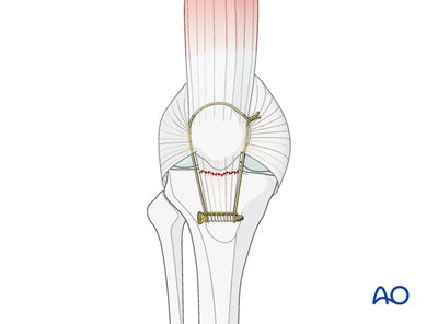 Patellar tendon repair for Extraarticular avulsion fracture