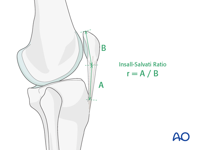 Patellar tendon repair for Extraarticular avulsion fracture