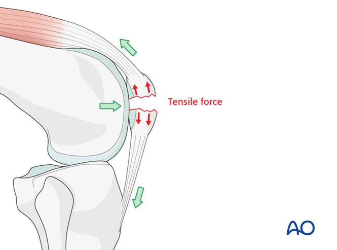 Tension band wiring for Complete articular, frontal/coronal simple ...