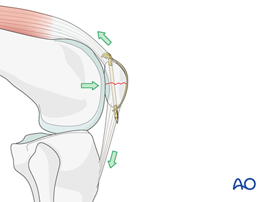 Cerclage compression suture for Complete articular, frontal/coronal ...