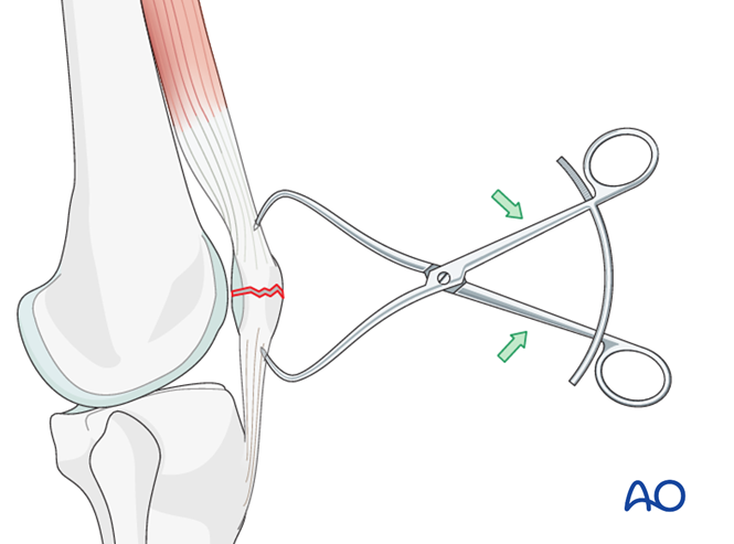 Cerclage compression wiring for Complete articular, frontal/coronal ...
