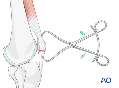 Cerclage compression wiring for Complete articular, frontal/coronal ...