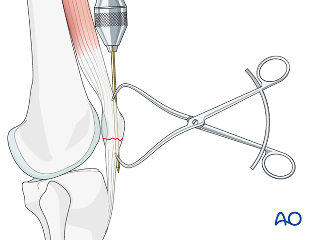 Cerclage compression wiring for Complete articular, frontal/coronal ...